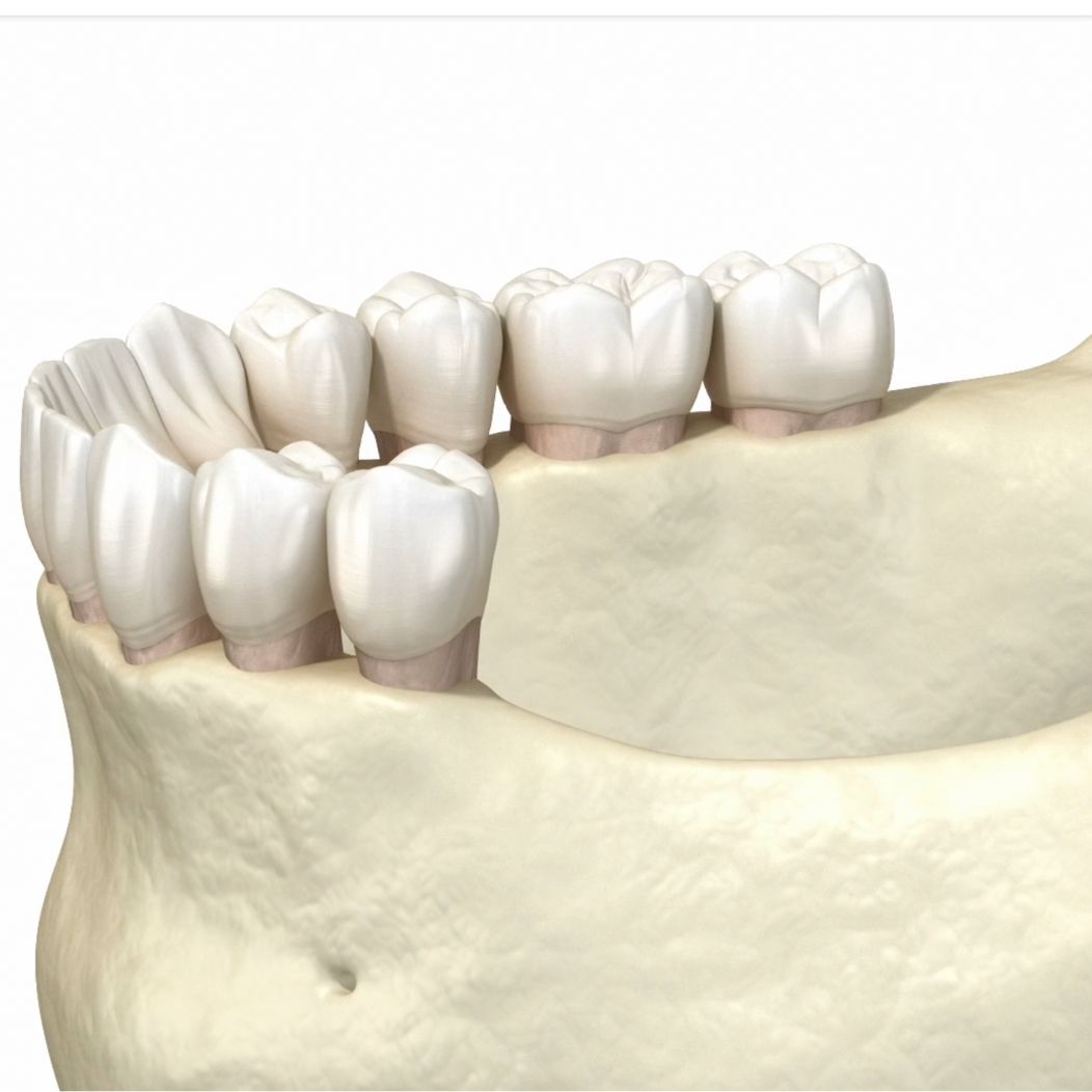 Ridge Augmentation | Arlington Oral Surgery